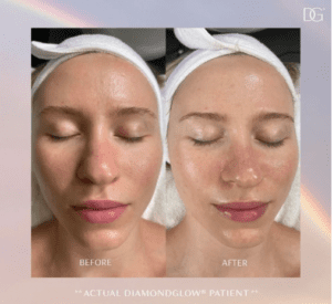Diamond Glow | Skin Rejuvenation | Arria MedSpa | NJ